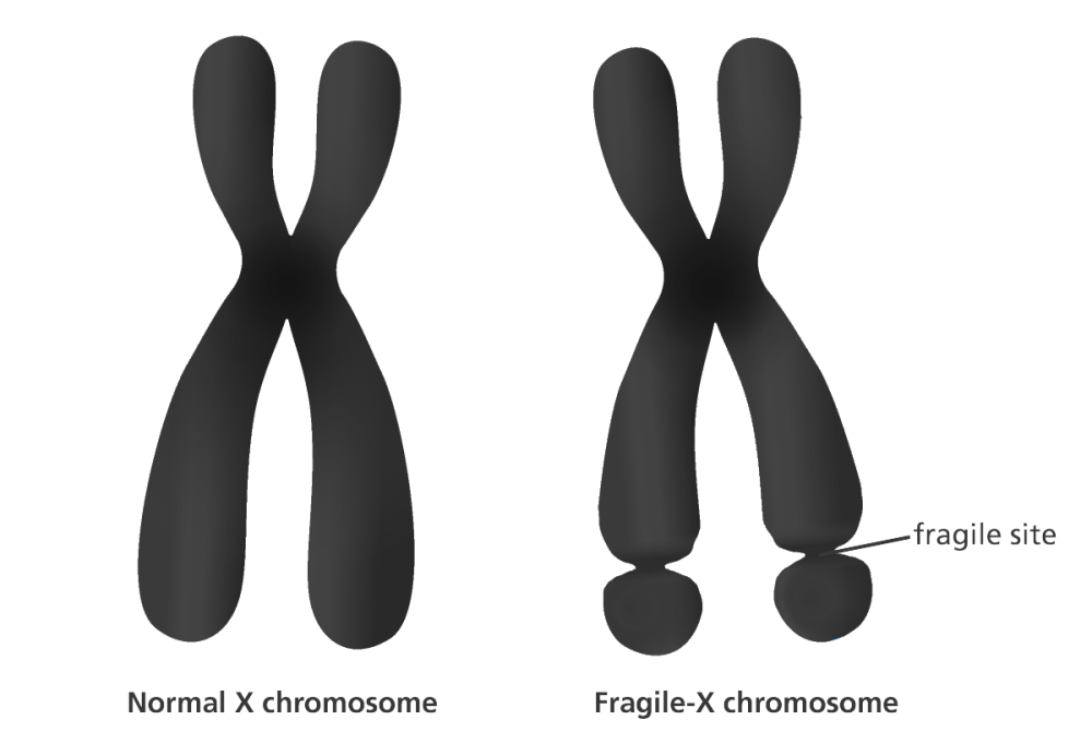 EHL Fragile X – Fragile X syndrome is a genetic condition that causes a ...